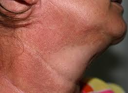 Poikiloderma - Blotchy Neck and it's Treatments – The Summit Skin Care ...